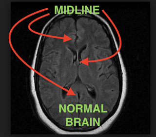Nathan's Journey: Midline Shift Update