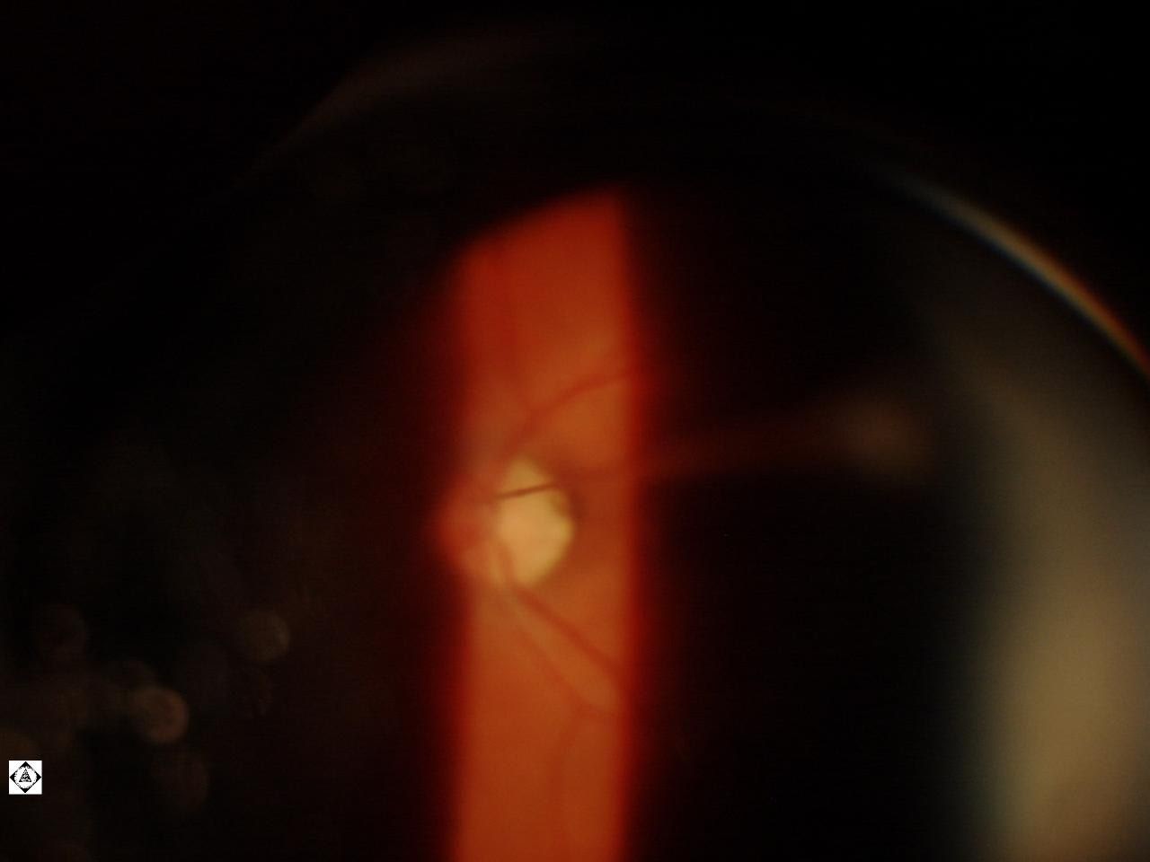 Sonoran Desert Eye Center: PERSISTENT HYALOID ARTERY