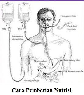 Nutrisi Enteral Dan Parenteral - Perumperindo.co.id