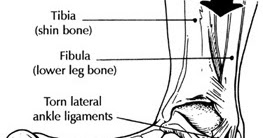 Penanganan untuk Keseleo Atau Terkilir Saat Berolahraga - Info Dokter