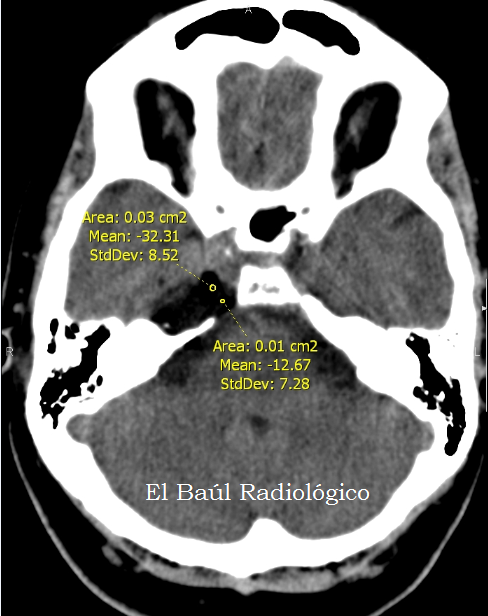El Baúl Radiológico: 2) QUISTE DERMOIDE INTRACRANEAL (Intracranial ...