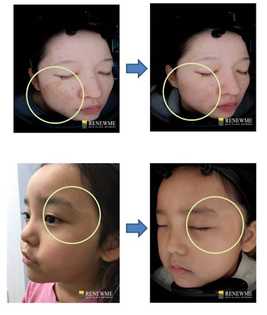 Renewme Skin Clinic: Birthmark, Café-Au-Lait Spot removal Laser treatment
