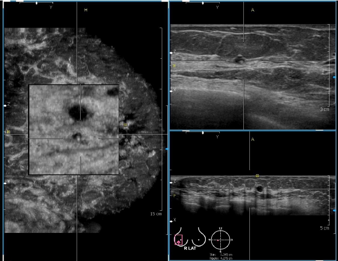 Espaço da Radiologia: MAMOGRAFIA DIGITAL, RESSONÂNCIA DE MAMA E ...