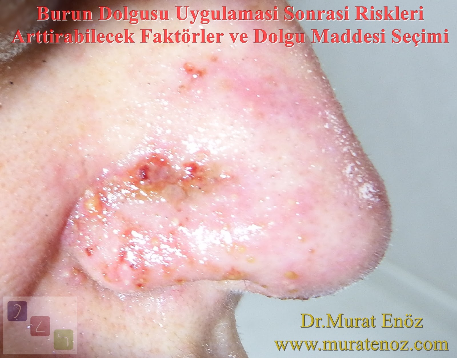 Selection of Filler Material and Factors to Increase Risks After Nose ...