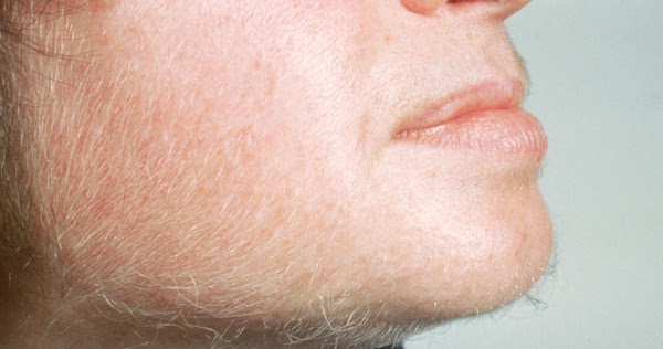 Lanugo Hair- All You Want to Know about It