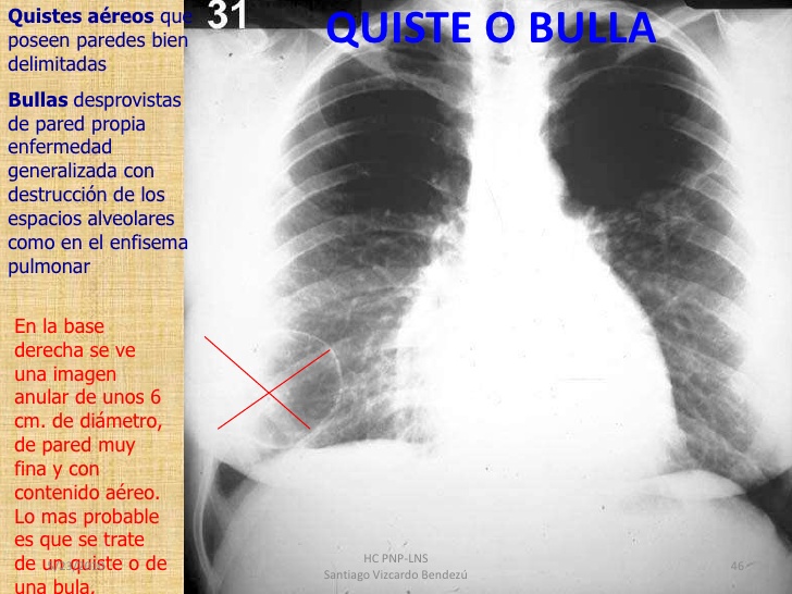 Dr. FreeTangas: Radiología Básica. Tele de Tórax. (Parte 2. Final.)