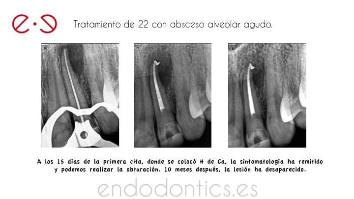 Endodoncia Microscópica en Zaragoza: Absceso apical agudo, con drenaje ...