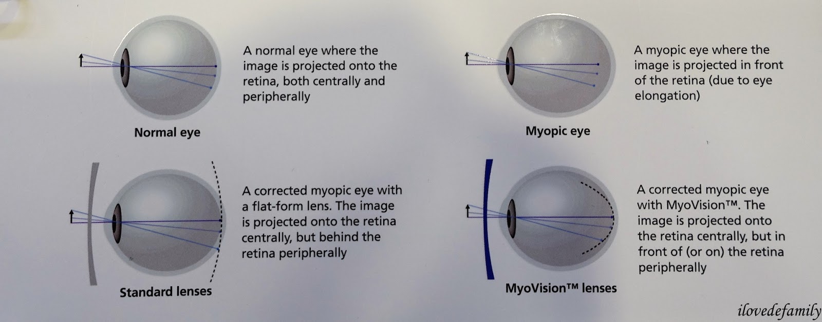 B. C. D. E. That's Us!: Of Myopia and Spectacles