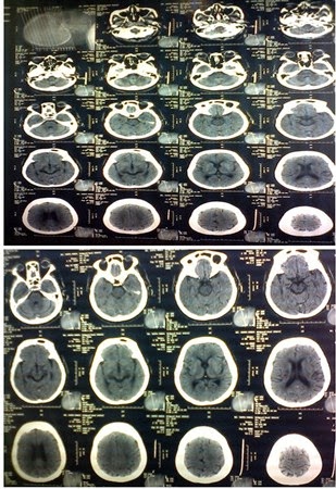Laporan Kasus Stroke Infark Medical Articles