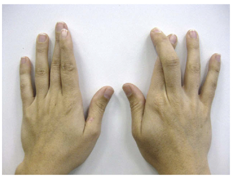 White Tower・White Jungle: [外科筆記] 整型外科・尺神經損傷評估・Assessment of Ulnar ...