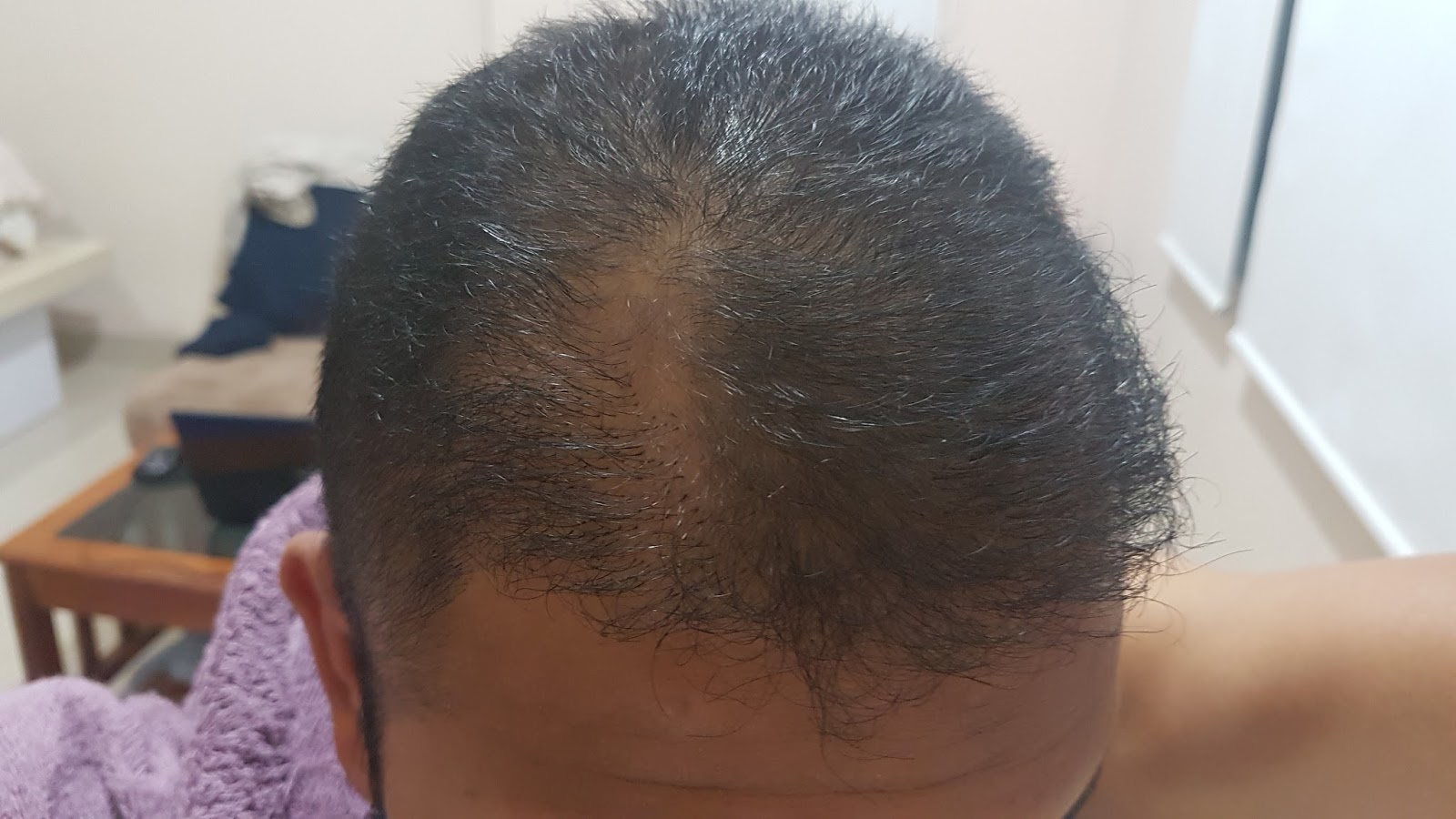 hair transplant experience - pengalaman transplantasi rambut / tanam ...
