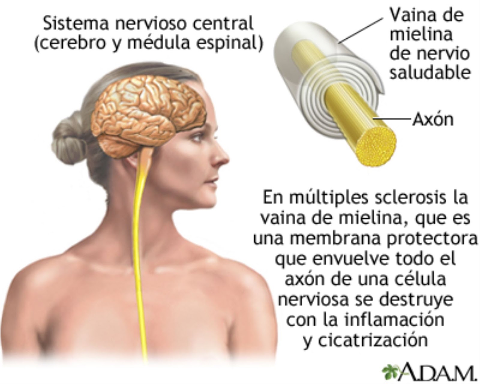 Ocho De Cada 100 000 Peruanos Sufren Esclerosis M ltiple Salud En