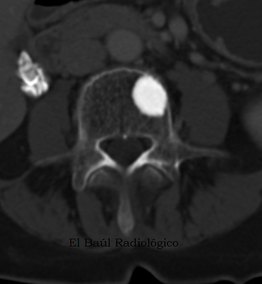 El Baúl Radiológico: ENOSTOSIS: ISLOTE ÓSEO (Bone Island: CT and MRI ...
