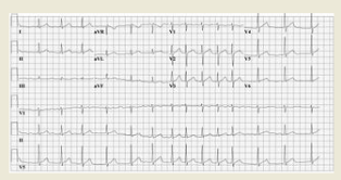 Mengetahui Atrial Fibrillation