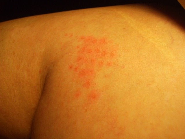 An Autoimmune Arthritic Systemic Life©: The Petechia is back and rashes ...