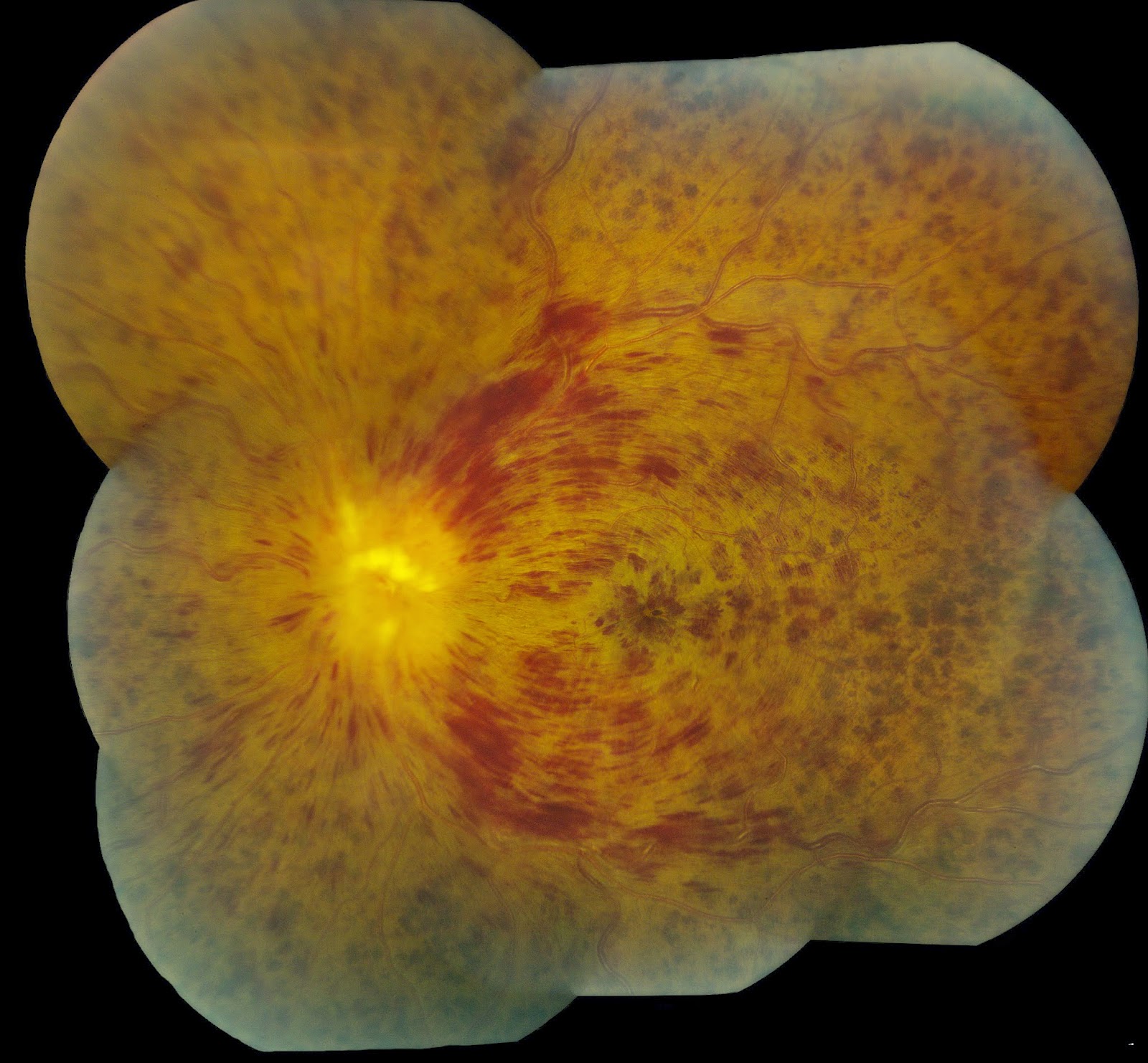 Whitman Images: CRVO: Central Retinal Vein Occlusion