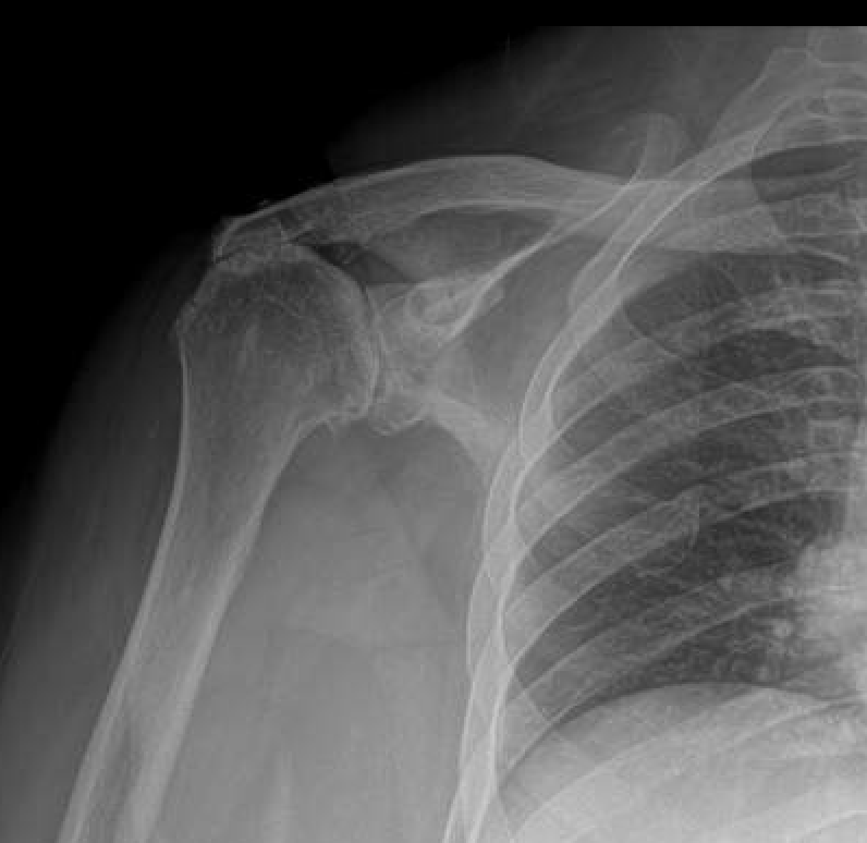 Shoulder and Elbow Surgery: Reverse total shoulder replacement for ...