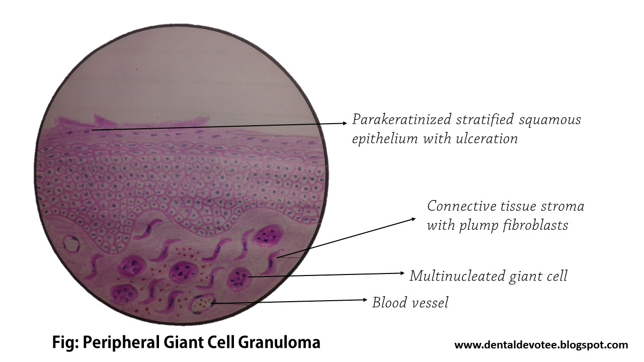 Peripheral Giant Cell Granuloma Histology