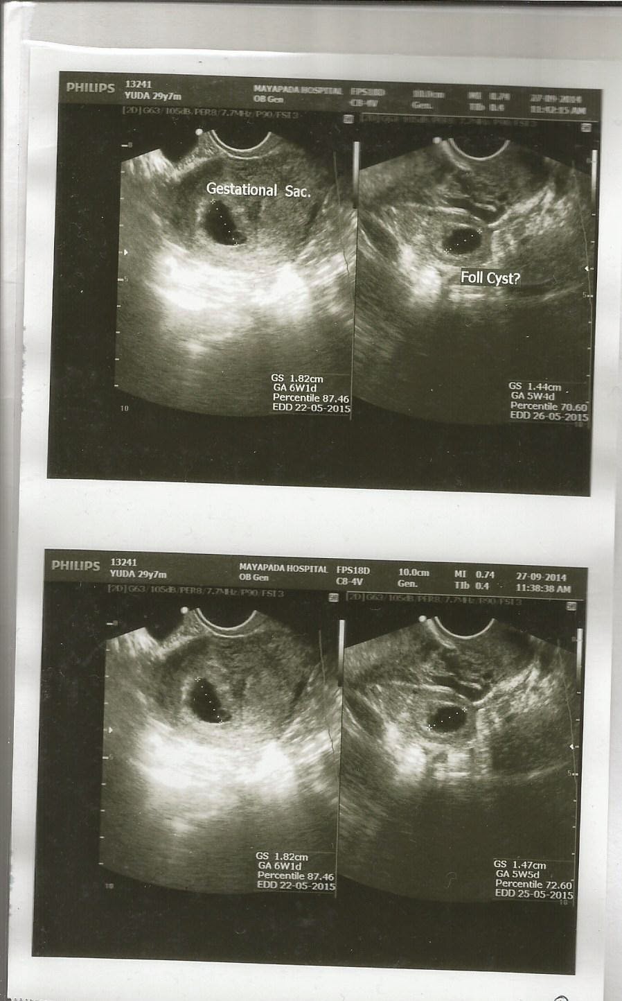 myfamily..mylife..mymiracle..myjourney: Kehamilan Kandungan usia 6 Minggu