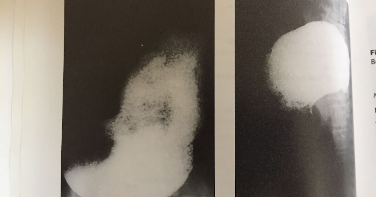 XRAYS GASTRIC OUTLET OBSTRUCTION