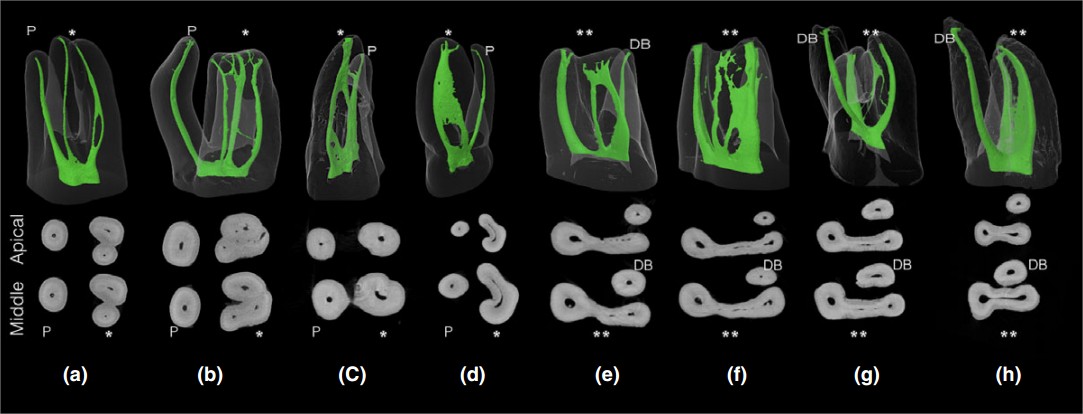 The Root Canal Anatomy Project: Fused Maxillary 2nd Molars ...
