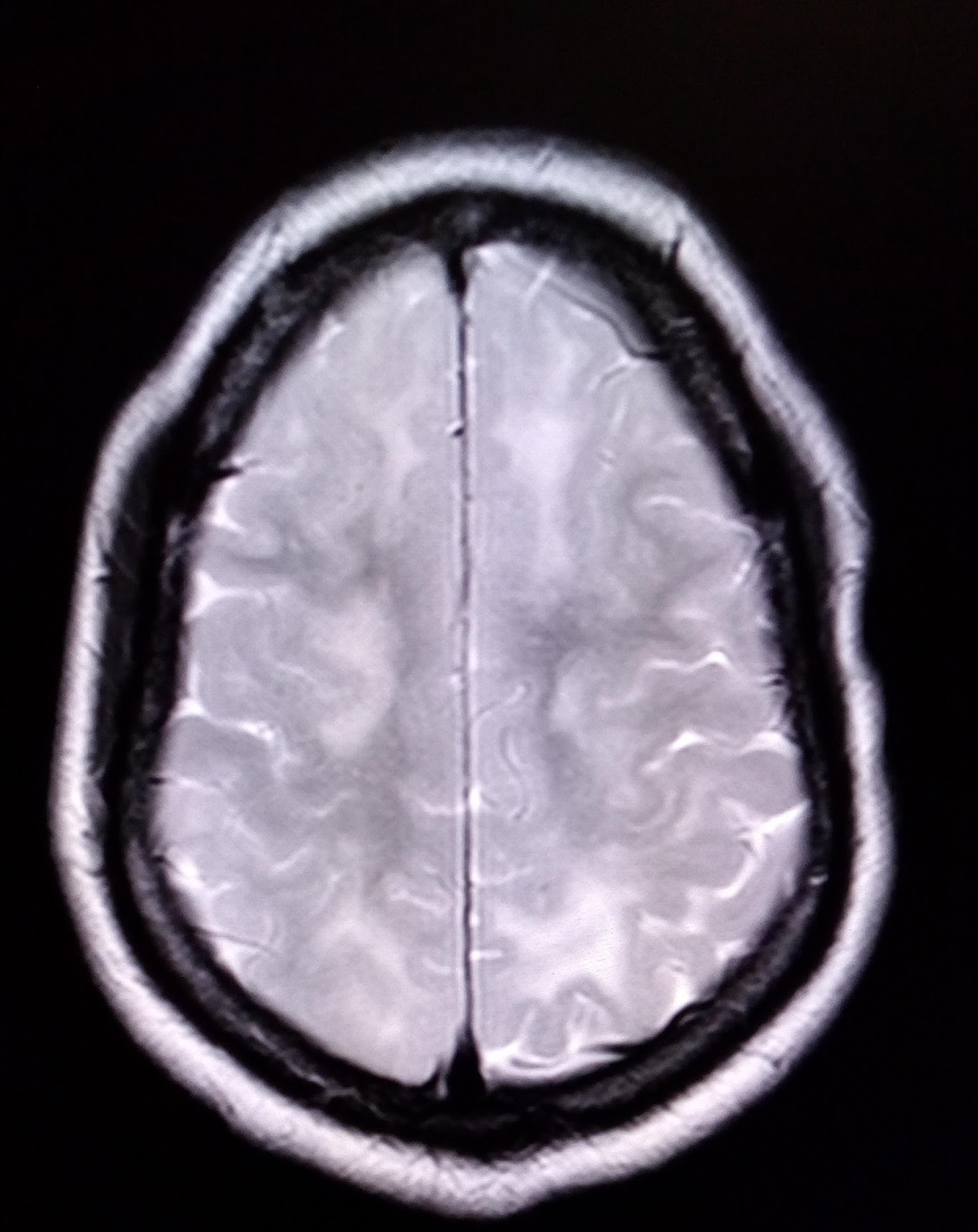 Progressive Multifocal Leukoencephalopathy: MRI - Sumer's Radiology Blog