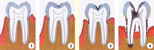Histopatologi Karies Email | Logbook Calon DRG