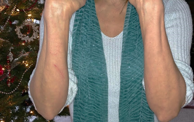 Allergy Rash from Christmas Tree: Causes and Remedies