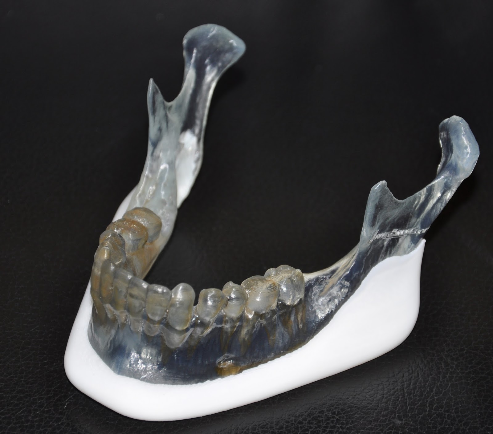 cemuvenezuela: MENTOPLASTIA DE AUMENTO