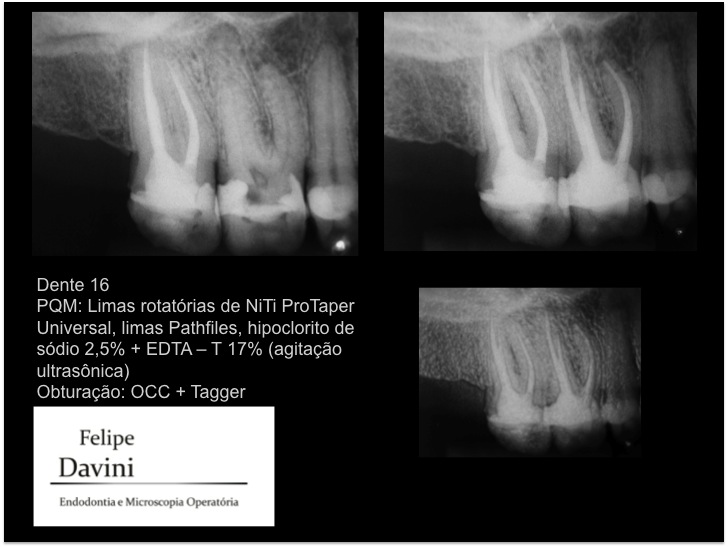 Davini - Endodontia e Microscopia Operatória: Tratamento endodôntico ...