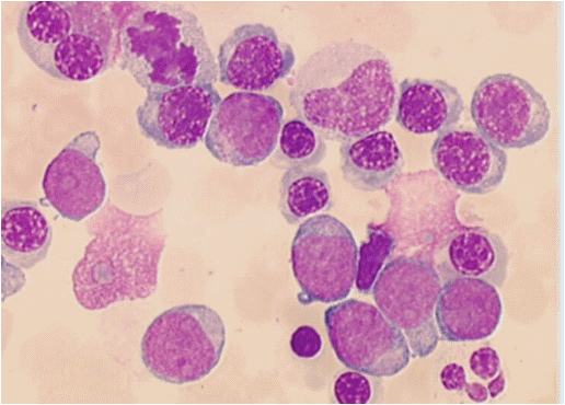 LEUCEMIE AIGUË MYELOBLASTIQUE(LAM) - BIOLOGIE MEDICALE