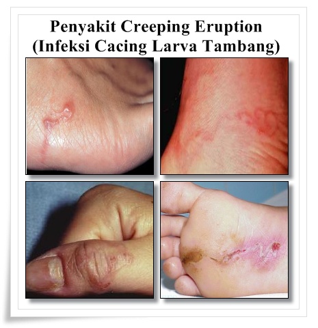 Obat Penyakit Creeping Eruption (Infeksi Cacing Larva Tambang) ~ Agen ...