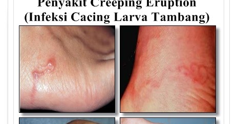 Obat Penyakit Creeping Eruption (Infeksi Cacing Larva Tambang) ~ Agen ...