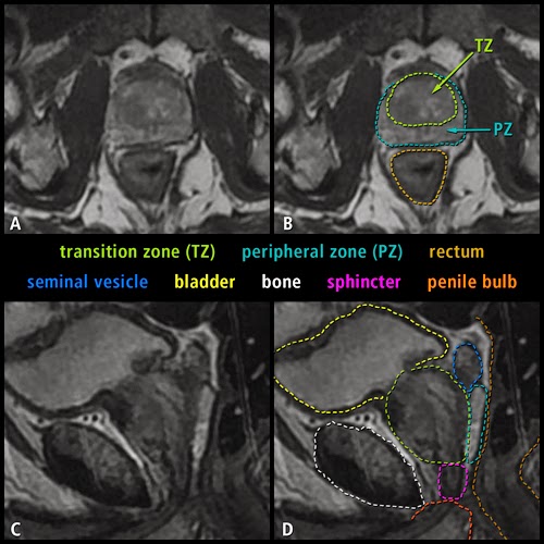 Prostate Gland Anatomy Mri