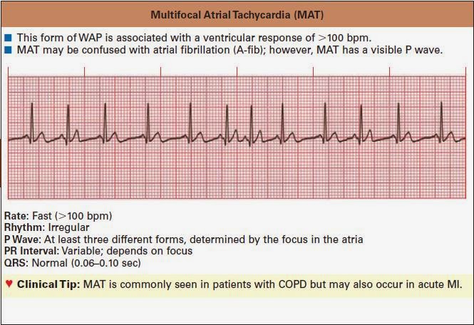 Multifocal Atrial Rhythm | INA - ECG