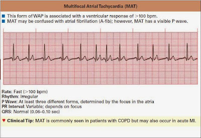 Multifocal Atrial Rhythm | INA - ECG