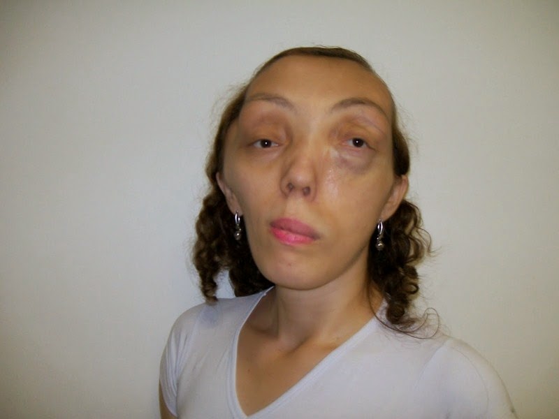 DR. NELSON MENEGHELLO ENDOCRINOLOGIA e CLÍNICA MÉDICA : ACROMEGALIA e ...