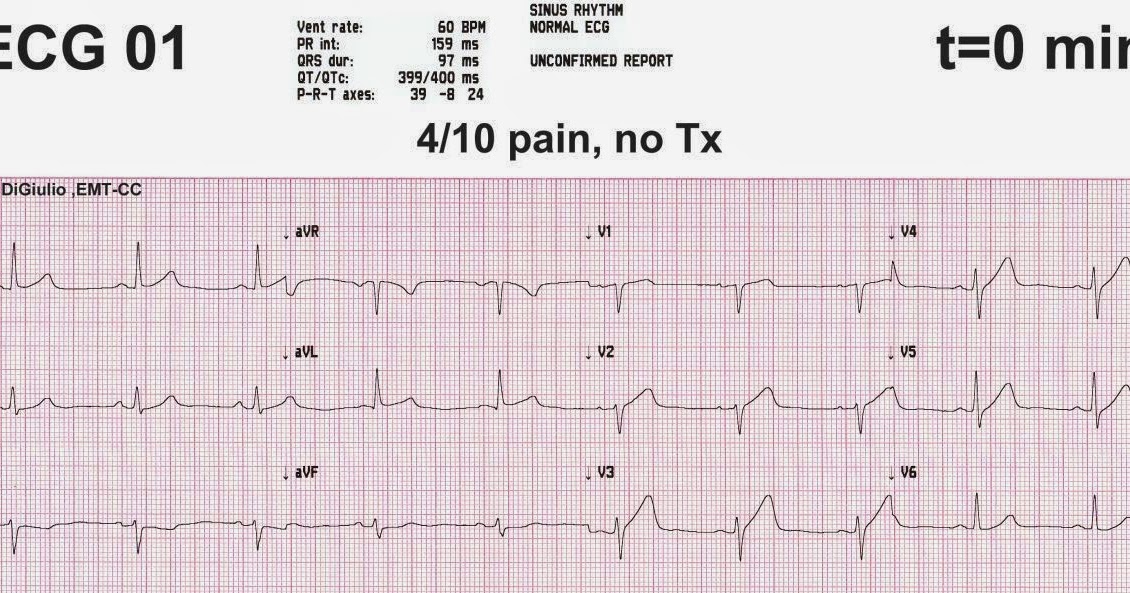 Dr. Smith's ECG Blog: Incredible Case Demonstrating the Value of ...