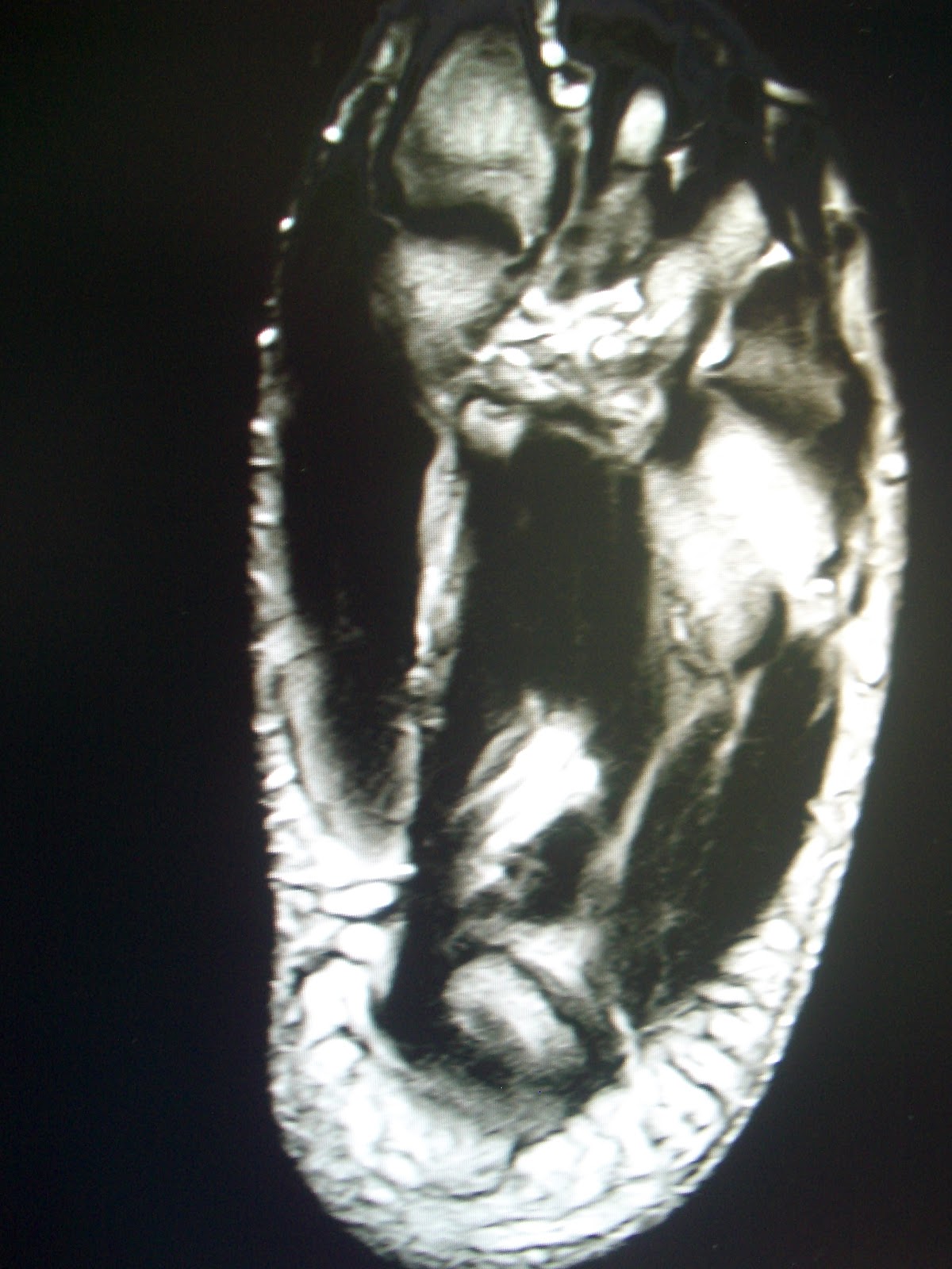 Podo Basas al Día: Fascitis plantar. Micosis intertriginosa. Papiloma ...