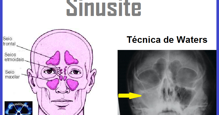 Tecnólogos em Radiologa: Sinusite , Técnica utilizada.