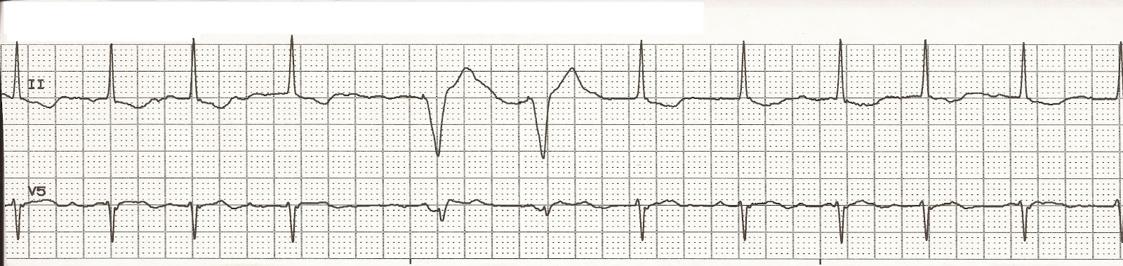 EKG Rhythm Strip Quiz 76