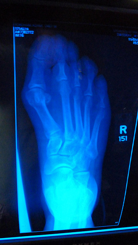 Savvy Working Gal: My Bunionectomy