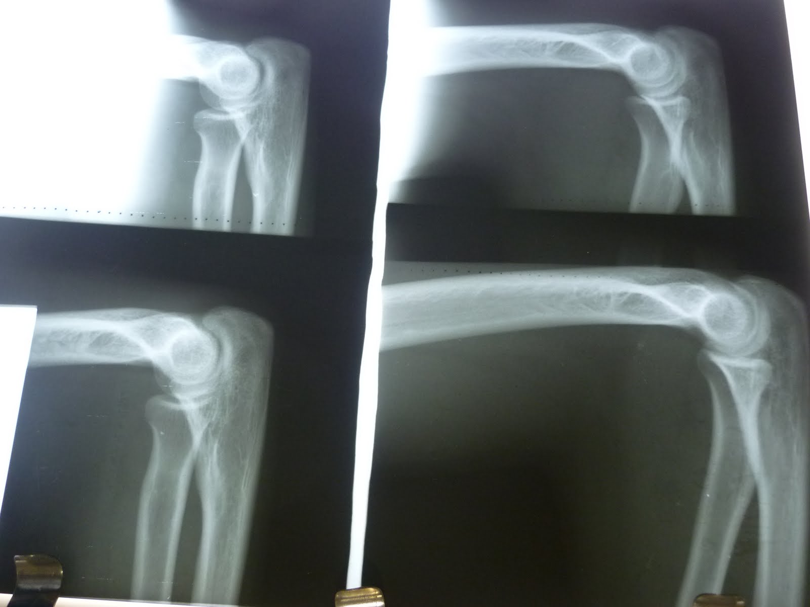 Rx011: Proyecciones Codo