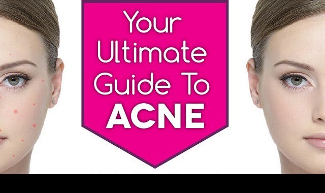 Your Ultimate Guide To Acne #infographic - Visualistan