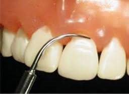 RINCON ODONTOLOGICO: ¿Qué es y cómo se forma el sarro dental?