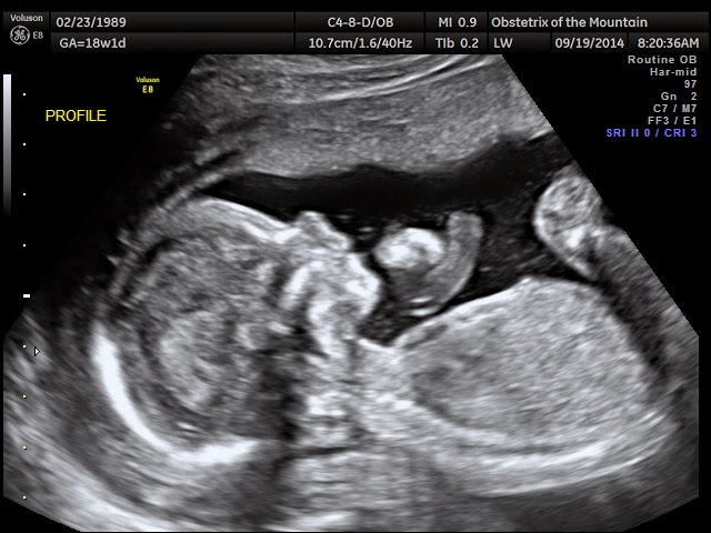 The Purcell Family: 18 Week Ultrasound
