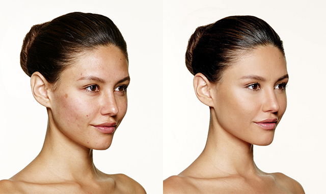 Home Remedies For Blemishes And Dark Spots On Face