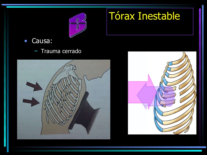 VENTILACION MECANICA EN TORAX INESTABLE: QUE ES EL TORAX INESTABLE