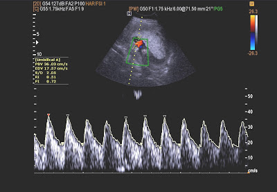 Pemeriksaan Ultrasonografi (USG) Trimester 2/3