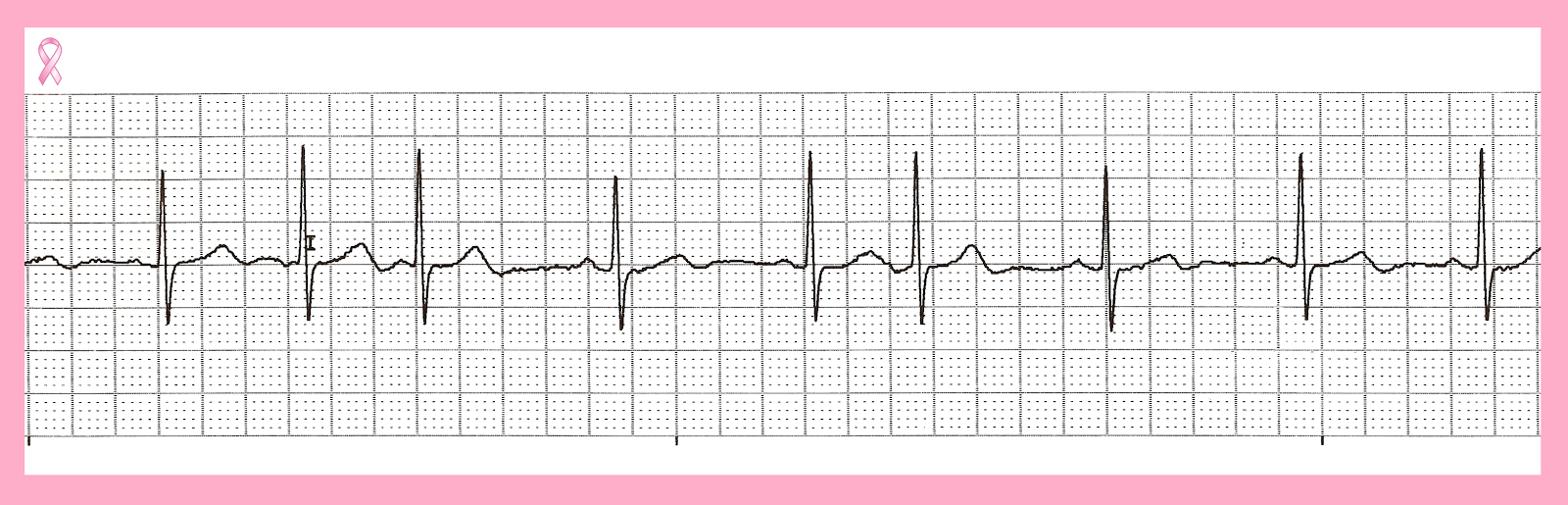 EKG Rhythm Quiz 283